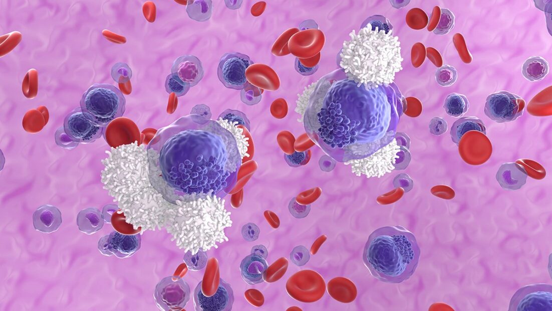 Ny immunterapi mot leukemi visar lovande effekt - forskning.se